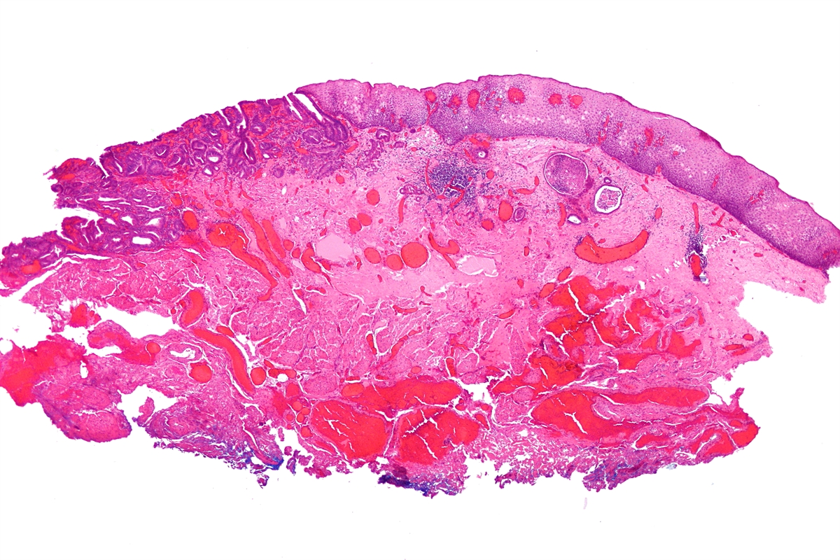 Il cancro della giunzione esofagogastrica: neoplasia gastrica o ...